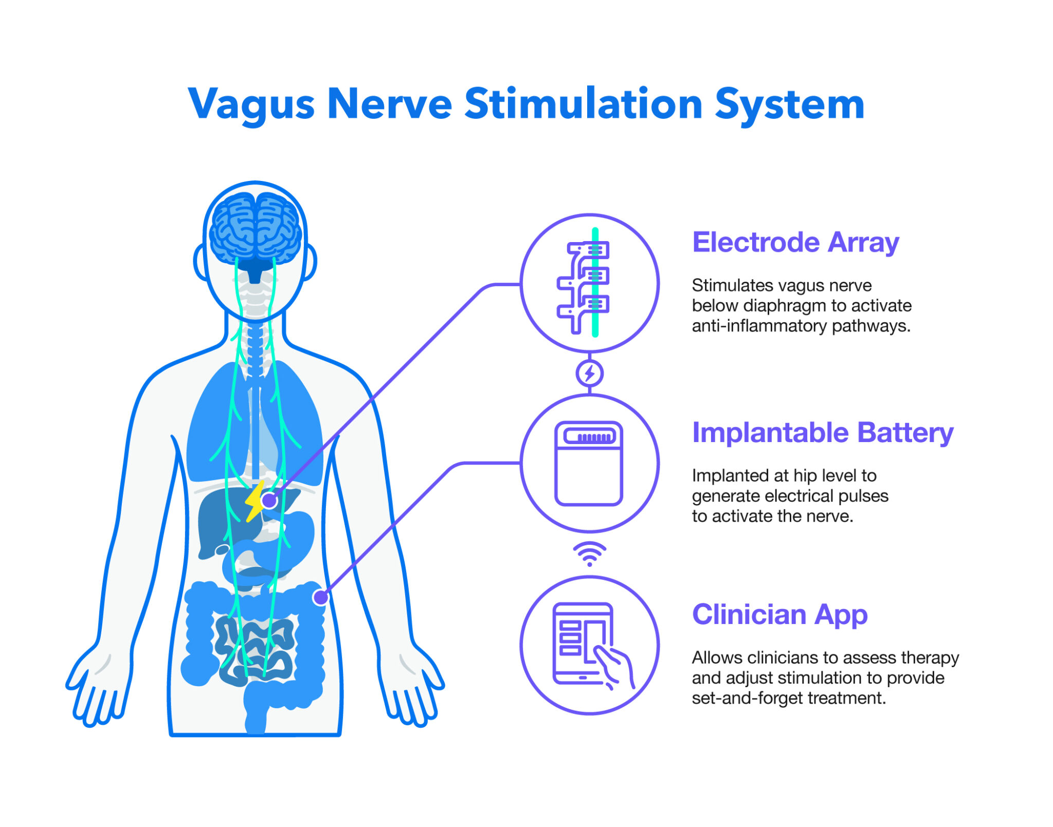 Our vagus nerve stimulation device implanted in first patient with Crohn's disease - Bionics ...